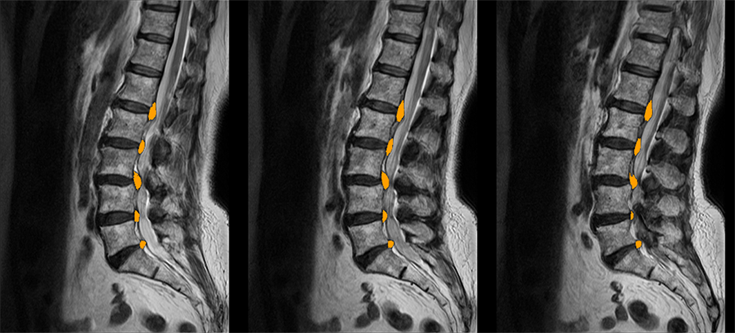 AI Software for Advanced Spine MRI Analysis | Minerva Spine