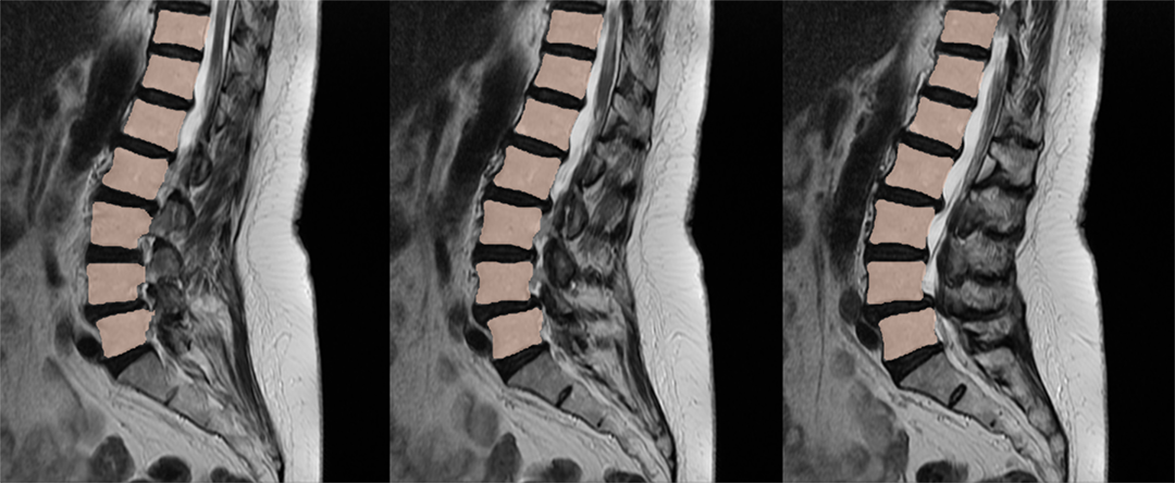 AI Software for Advanced Spine MRI Analysis | Minerva Spine