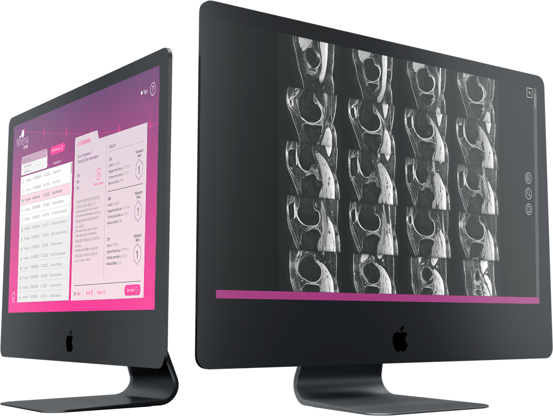 AI Software for Advanced Knee MRI Analysis | Minerva Knee